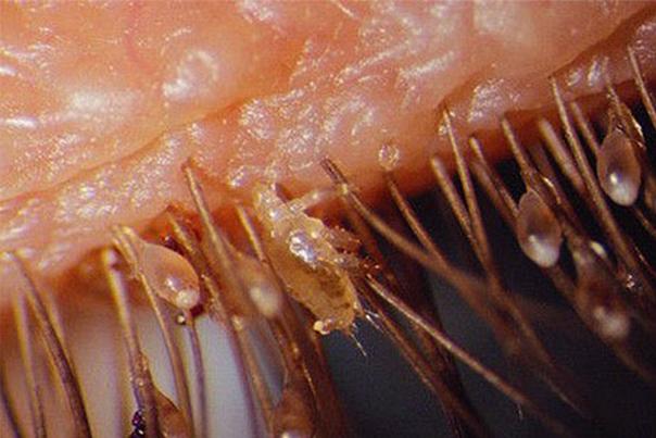 Safe head lice treatment NO chemicals